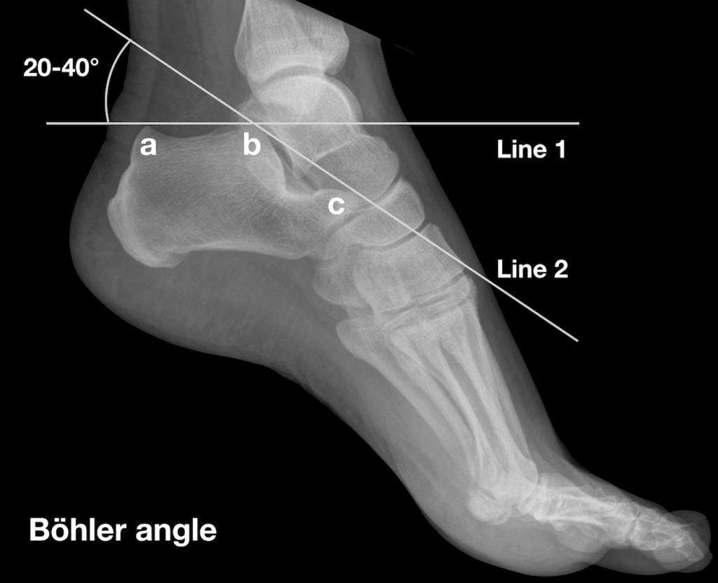 Eponymous foot injuries • LITFL • Medical Eponym Library
