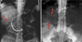 Rigler sign • LITFL • Medical Eponym Library