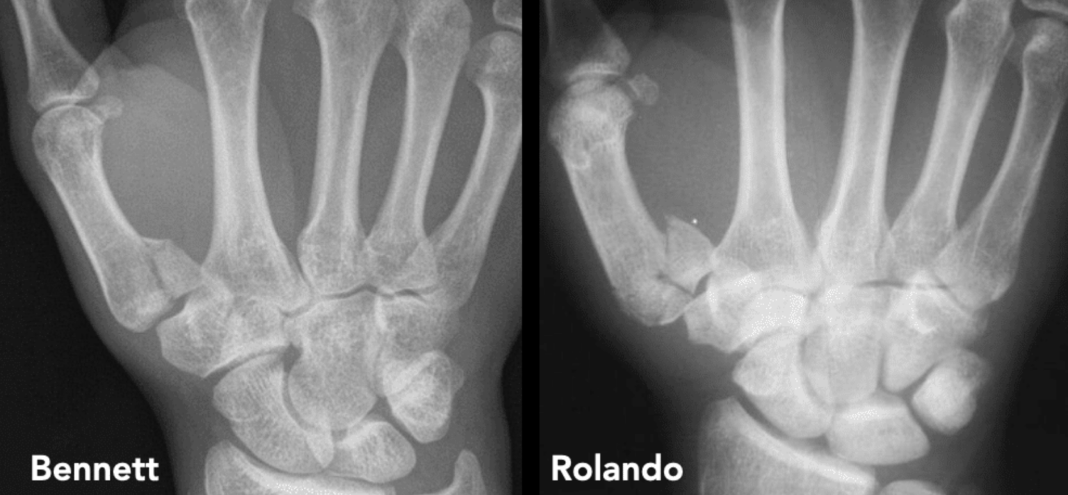 Rolando fracture • LITFL • Medical Eponym Library