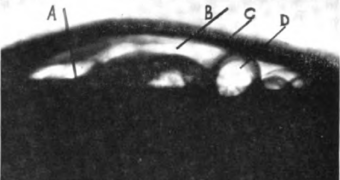 Rigler sign • LITFL • Medical Eponym Library