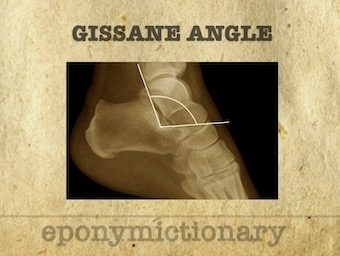 Gissane angle Archives • LITFL