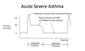 Pressure versus Time Graph • LITFL