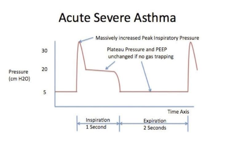Pressure versus Time Graph • LITFL
