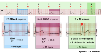 ECG Rate Interpretation • LITFL Medical Blog • ECG Library Basics