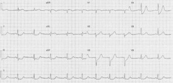 ECG Case 100 • LITFL • ECG Top 100 Self-Assessment Quiz