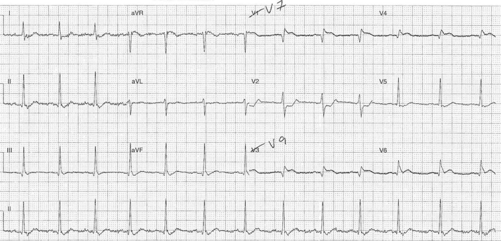 ECG Case 103 • LITFL • ECG Top 100 Self-Assessment Quiz