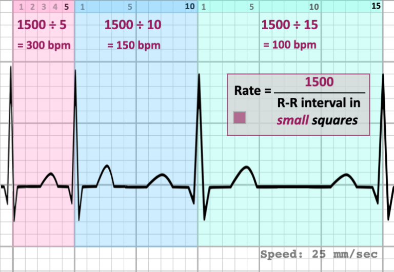 ECG Rate Interpretation • LITFL Medical Blog • ECG Library Basics