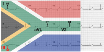 Killer ECG Patterns: Part 2 • LITFL • ECG Library