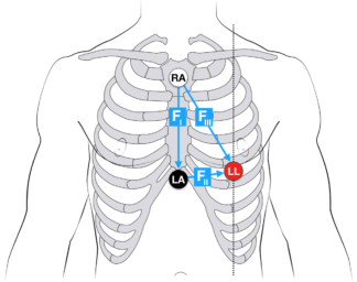Epsilon Wave • LITFL Medical Blog • ECG Library Basics