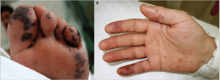 Janeway lesions • LITFL • Medical Eponym Library