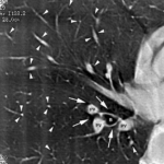 Charles Macklin • LITFL • Medical Eponym Library