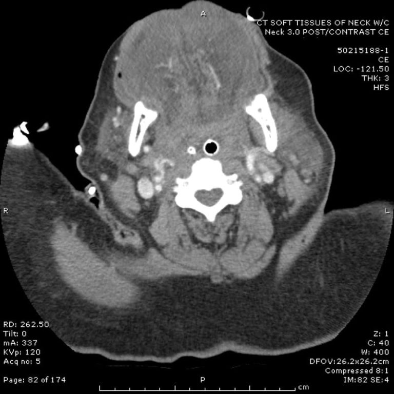 Rorschach Test Revealed • LITFL • Clinical Case Immunology