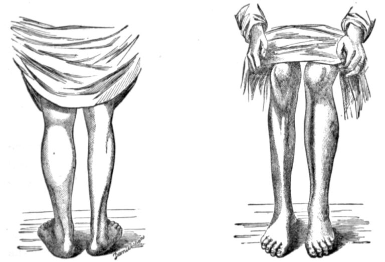 Howard Henry Tooth • LITFL • Medical Eponym Library