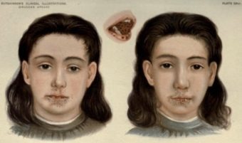 Peutz-Jeghers syndrome • LITFL • Medical Eponym Library