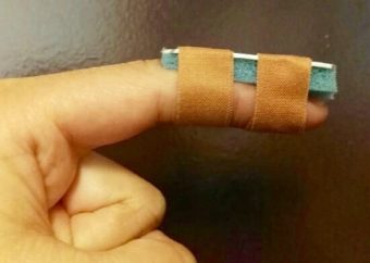 Mallet Finger • LITFL • Trauma Library