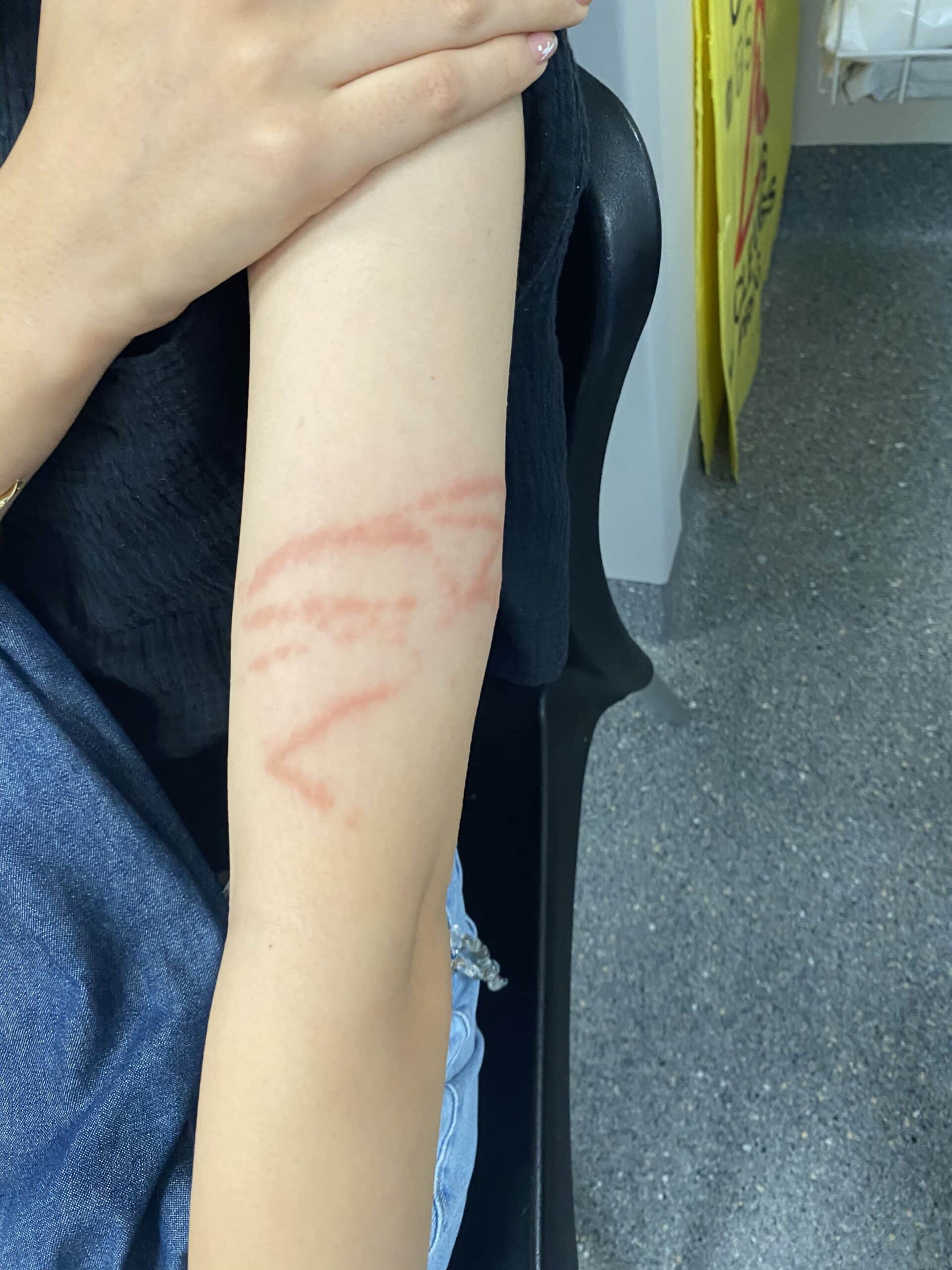 Bluebottle Jellyfish • LITFL • Toxinology Library