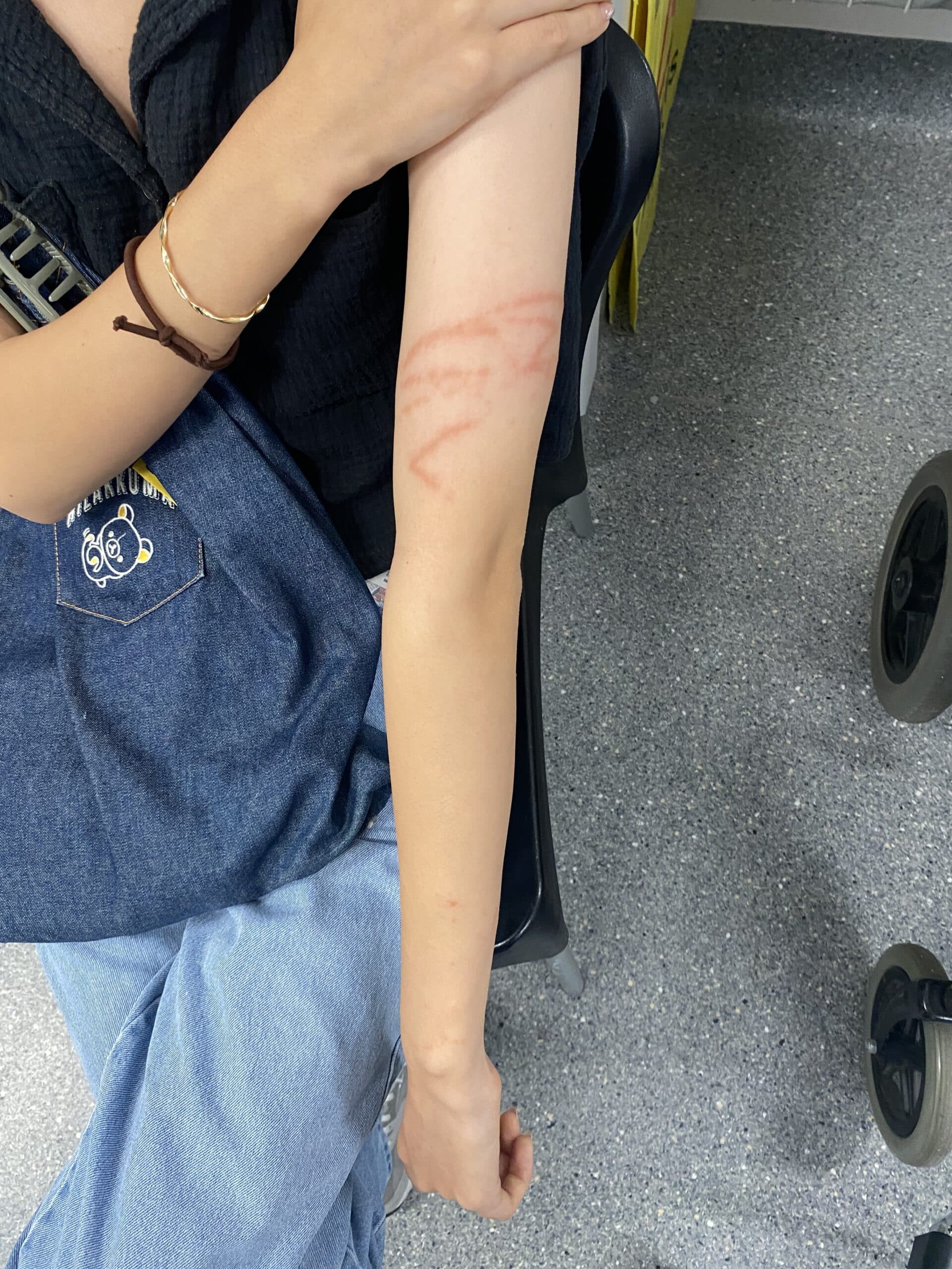 Bluebottle Jellyfish • LITFL • Toxinology Library