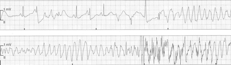 ECG Case 101 • LITFL • ECG Top 100 Self-Assessment Quiz