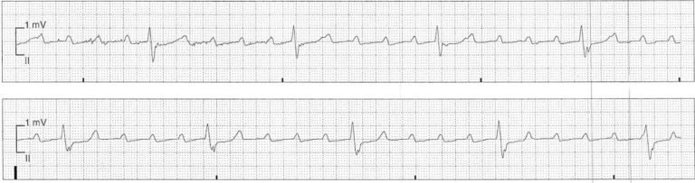 ECG Case 108 • LITFL • ECG Top 100 Self-Assessment Quiz
