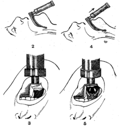 Macintosh laryngoscope • LITFL • Medical Eponym Library