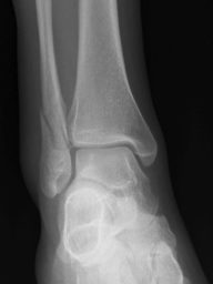 Danis-Weber classification • LITFL • Medical Eponym Library