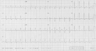 AVNRT for two • LITFL • ECG Library Diagnosis