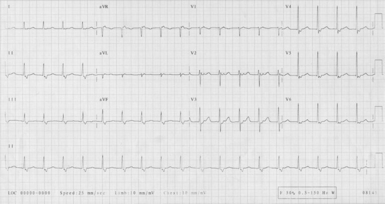 AVNRT for two • LITFL • ECG Library Diagnosis