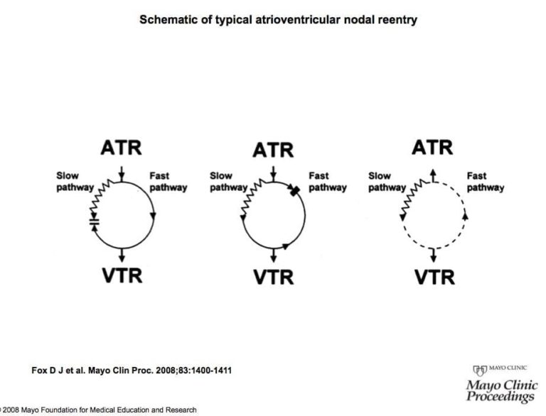 AVNRT for two • LITFL • ECG Library Diagnosis