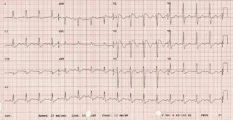 What is Brugada Syndrome? • LITFL