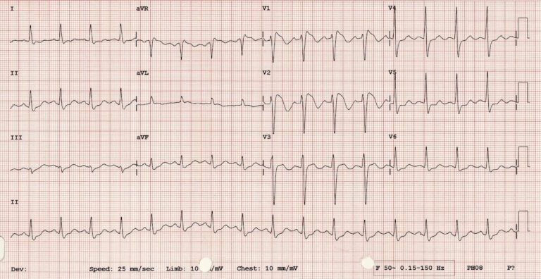 What is Brugada Syndrome? • LITFL