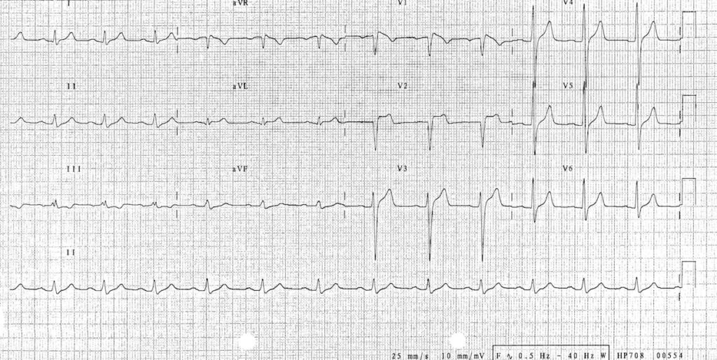 What is Brugada Syndrome? • LITFL