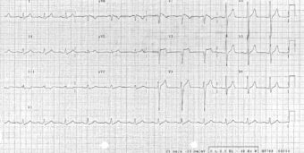 What is Brugada Syndrome? • LITFL