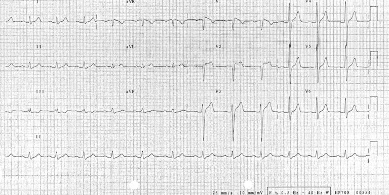 What is Brugada Syndrome? • LITFL
