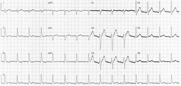ECG Case 118 • LITFL • ECG Top 100 Self-Assessment Quiz