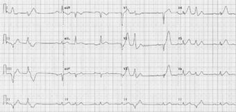 Anterior Myocardial Infarction • LITFL • ECG Library Diagnosis