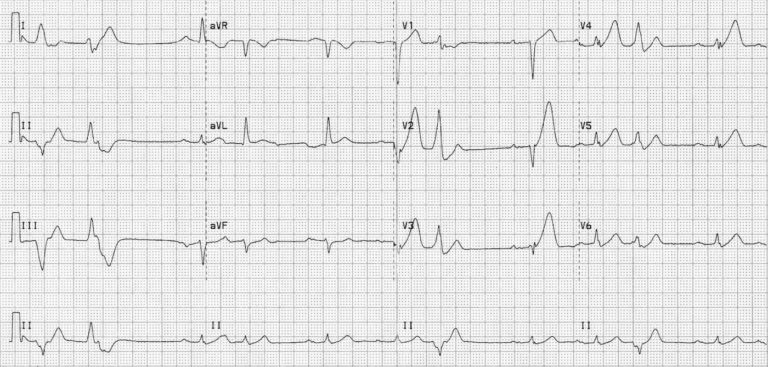 Anterior Myocardial Infarction • LITFL • ECG Library Diagnosis
