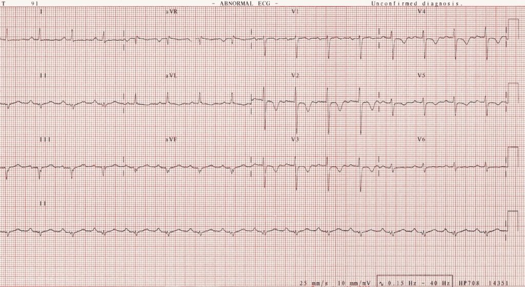 ICE 016 Delayed presentation chest pain • LITFL • ICE Clinical Cases