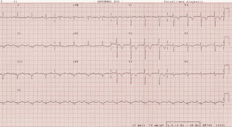 ICE 016 Delayed presentation chest pain • LITFL • ICE Clinical Cases