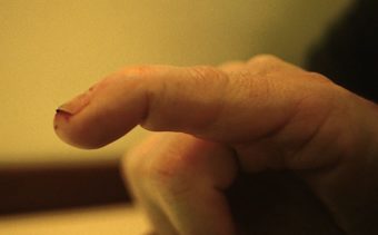Mallet Finger • LITFL • Trauma Library