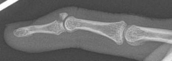 Mallet Finger • LITFL • Trauma Library