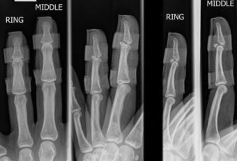 Mallet Finger • LITFL • Trauma Library