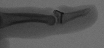 Mallet Finger • LITFL • Trauma Library