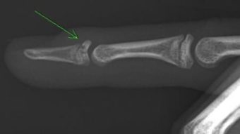 Mallet Finger • LITFL • Trauma Library