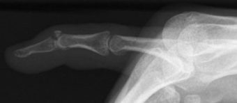 Mallet Finger • LITFL • Trauma Library