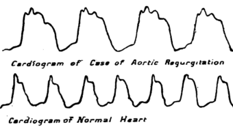 Eponyms of Aortic Regurgitation • LITFL • Medical Eponym Library