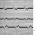 Delta Wave • LITFL Medical Blog • ECG Library Basics
