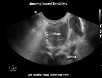Tonsillar ultrasound • LITFL • Ultrasound library