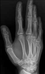 Boxer's fracture • LITFL • Trauma Library
