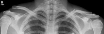 Clavicle fractures • LITFL • Trauma Library