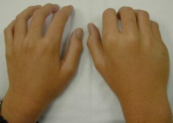 Boxer's fracture • LITFL • Trauma Library